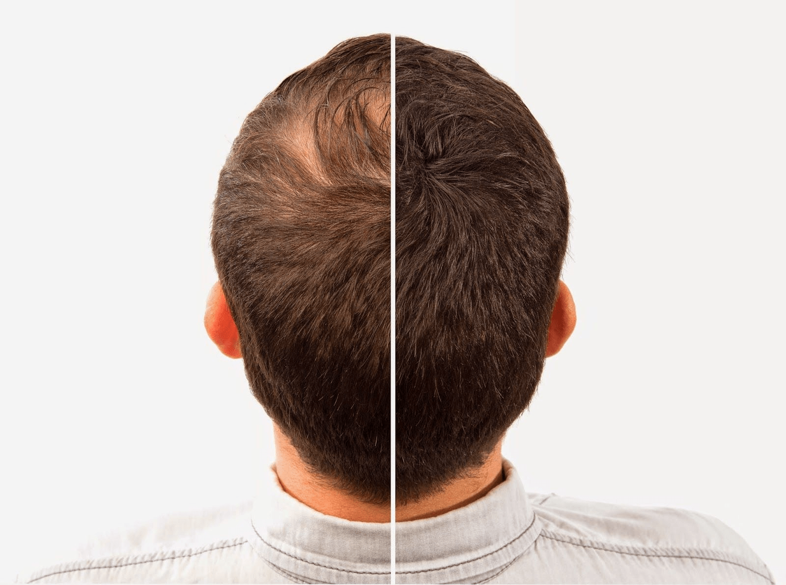 Hair Transplant in Turkey: A Complete Guide for 2024 - Hair Transplant ...