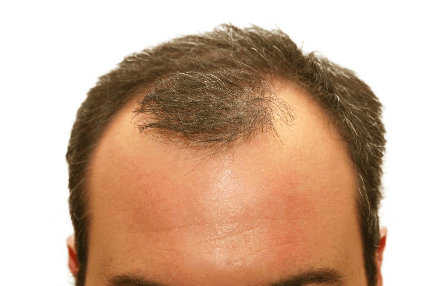 5 Things You Need to Know About M-Shaped Hairlines - Hair Transplant ...