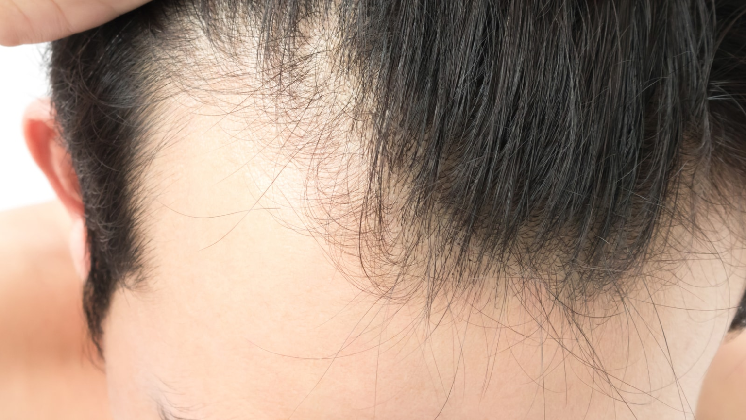 5 Things You Need to Know About M-Shaped Hairlines - Hair Transplant ...