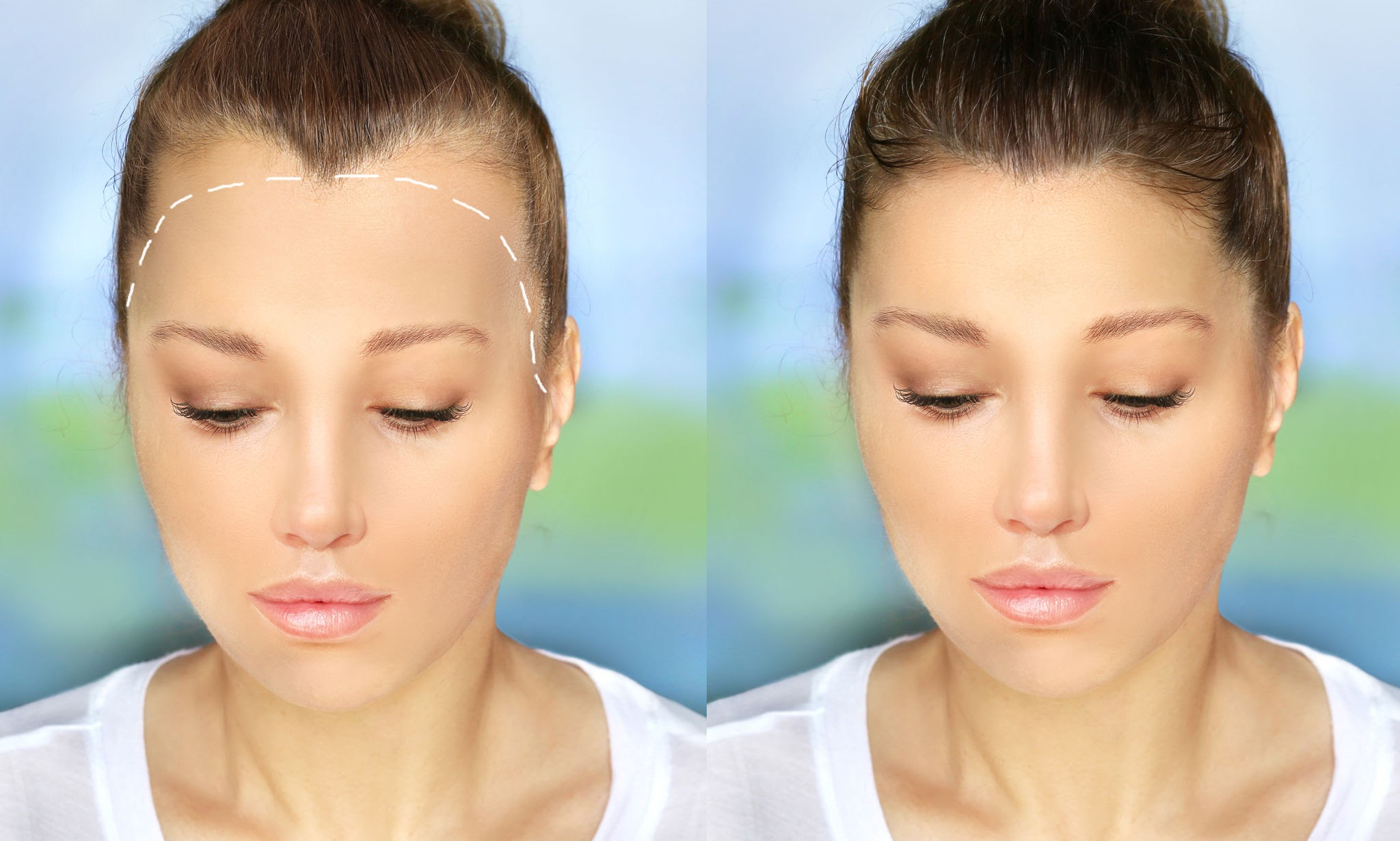 Forehead Reduction Surgery: Costs, Benefits, Results and More - Hair ...