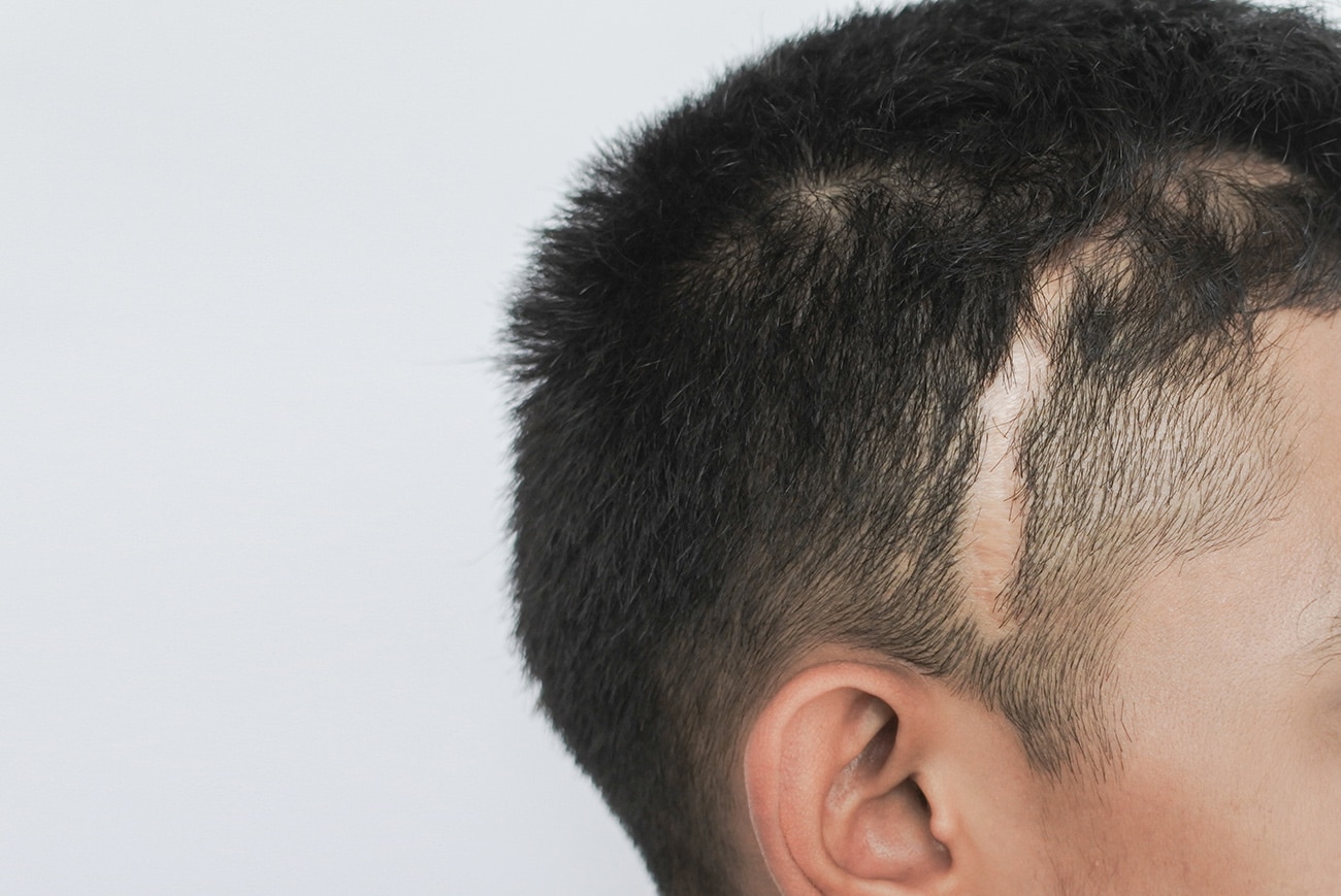 Scars are No Problem Anymore: Bring Your Hair Back - Hair Transplant ...