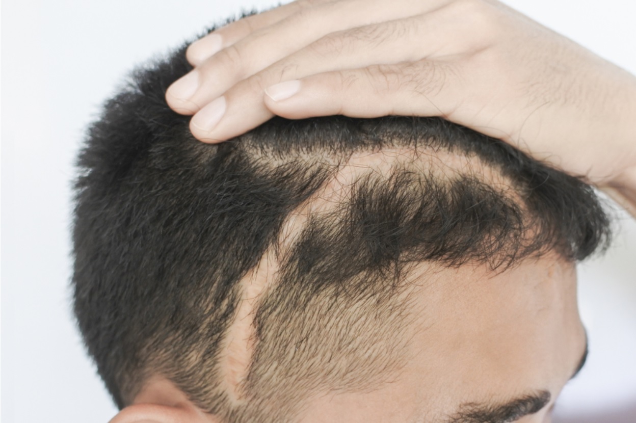 Scars are No Problem Anymore: Bring Your Hair Back - Hair Transplant ...