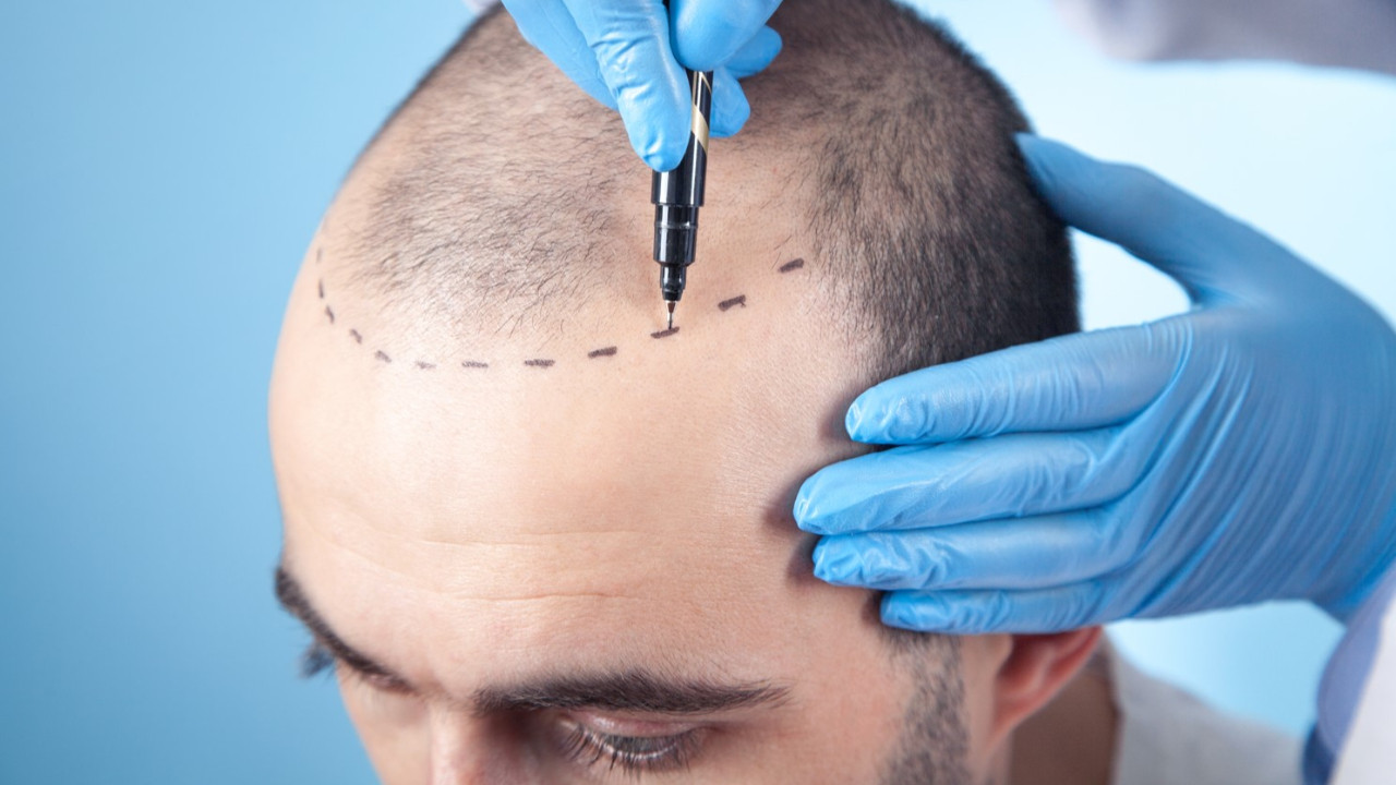 The Best Hair Transplant Technique: Get to know FUE - Hair Transplant ...