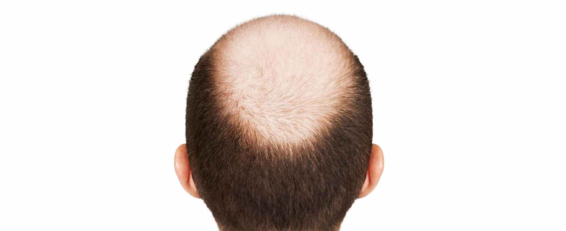 Crown Area Hair Transplant: Healthy and Lush Hair - Hair Transplant ...