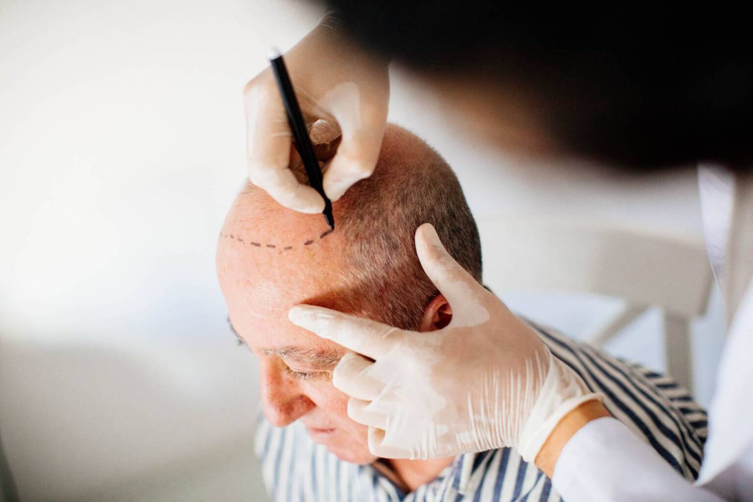 The Age at Which Baldness Starts: When Do You Lose Your Hair? - Hair ...
