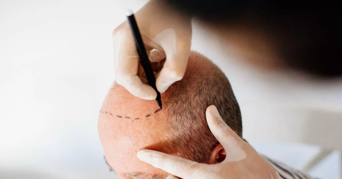 Wird der Erfolg der Türkei bei Haartransplantationen übertrieben ...